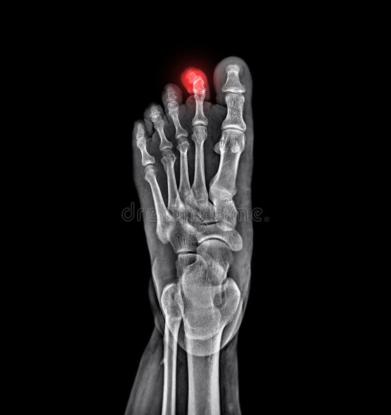 Foot X-ray Image AP and Lateral View Isolated on Black Background Stock ...