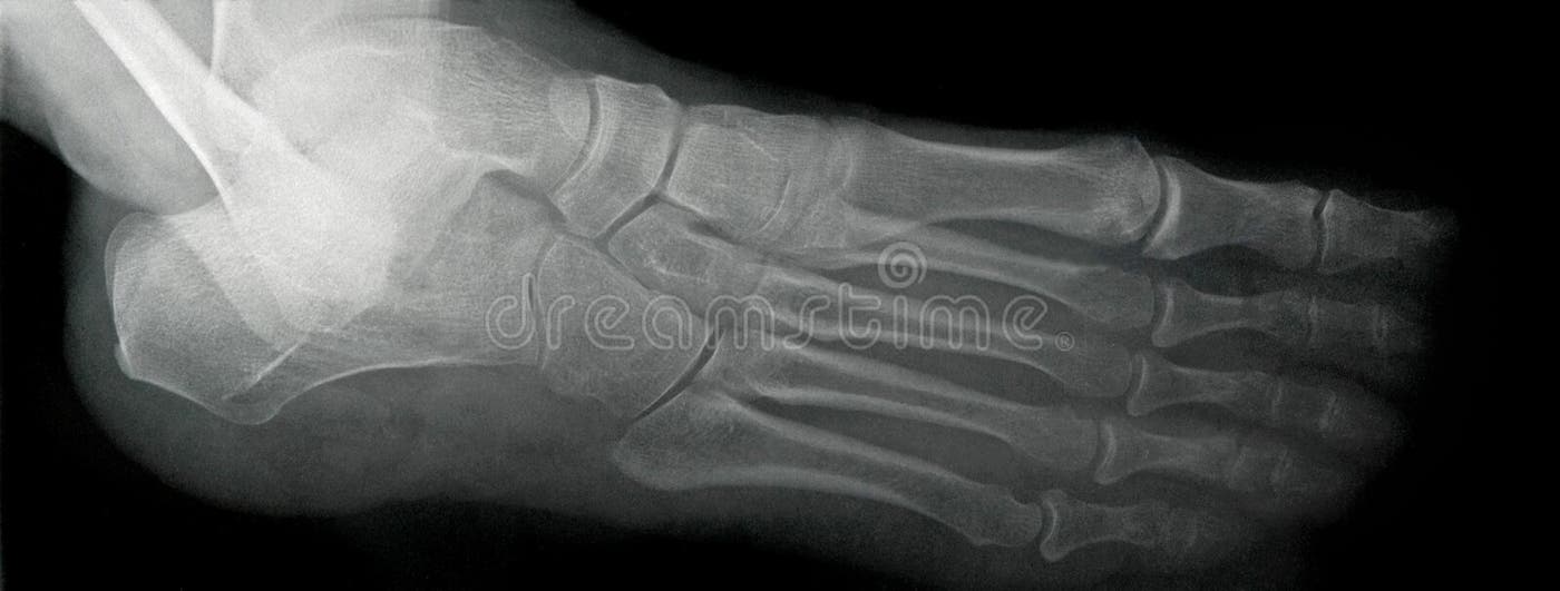 Navicular Xray Lateral View Stock Photos - Free & Royalty-Free Stock ...