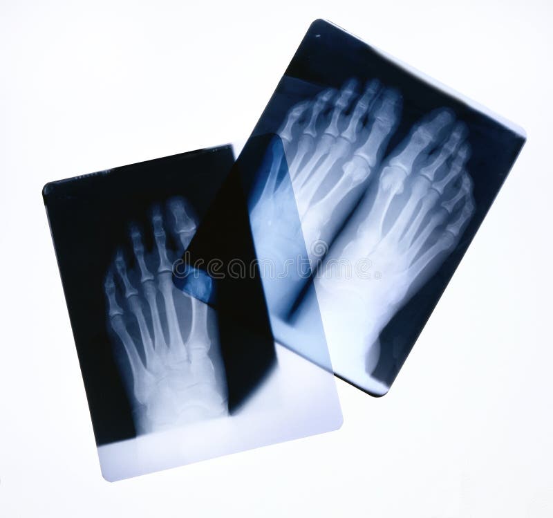 Foot X-rays stock image. Image of medicine, diagnose, doctor - 7559209