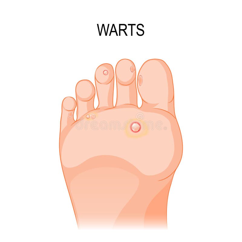 Plantar Warts stock illustration. Illustration of health - 41750683