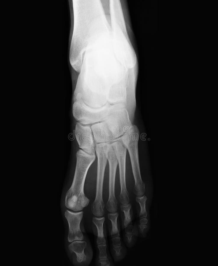 Foot Xray Showing Soft Tissue Gas in Patient with Necrotizing ...