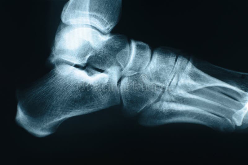 Foot Xray Showing Soft Tissue Gas in Patient with Necrotizing ...