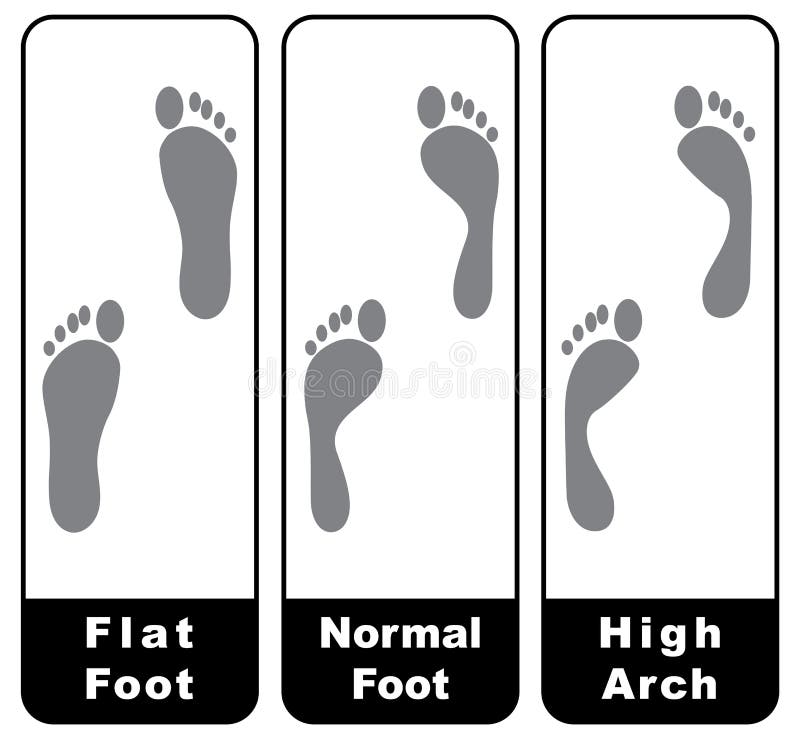 Flat foot, high arch stock vector. Illustration of medicine - 32429113
