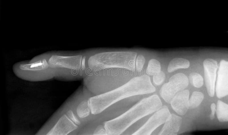 Forefinger stock image. Image of injury, arthritis, screen - 2047687