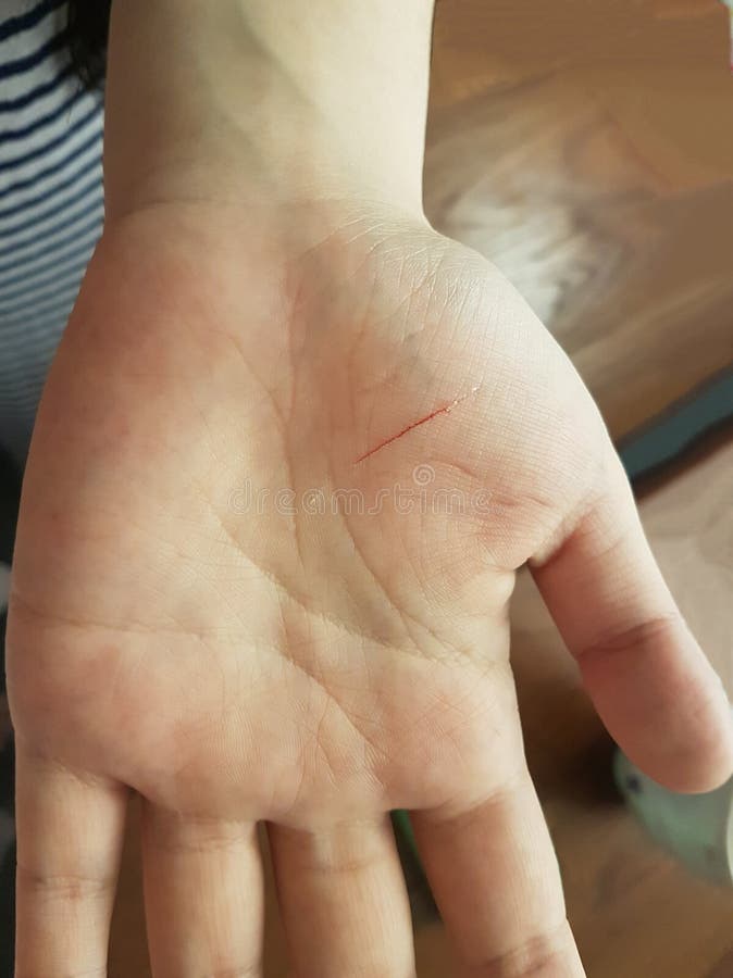 Blood on the Palm of a Man Against the Backdrop of Greenery. Typical ...