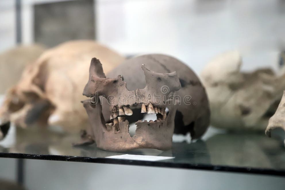 Forensic Anthropology. Human Bone Remains for Study in a Laboratory ...