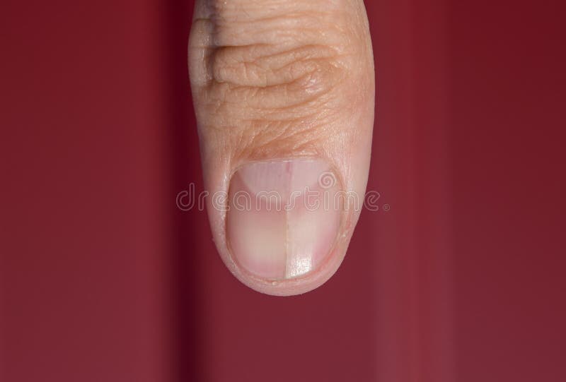 Cleft Fingernail