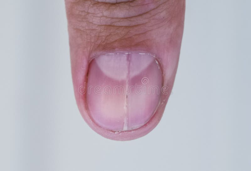 Cleft Fingernail