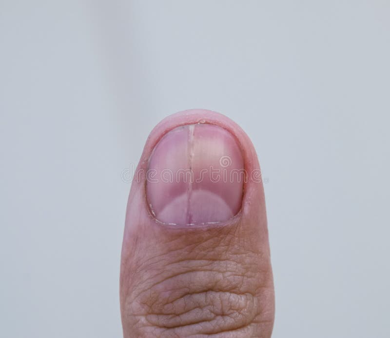 Cleft Fingernail
