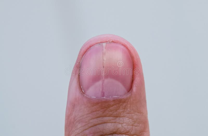 Forked Nail on the Thumb. Dilation of the Nail, Traumatic Pathology ...