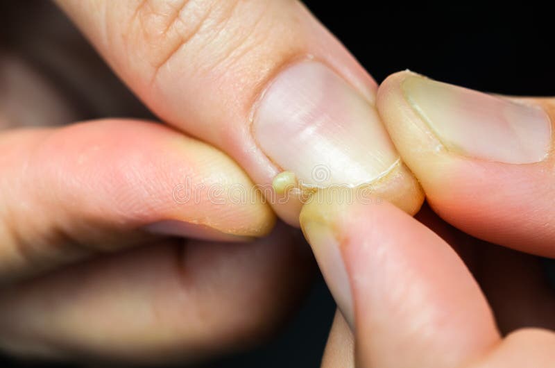 Exprimir La Herida De La Nuca Del Absceso Imagen de archivo - Imagen de ...