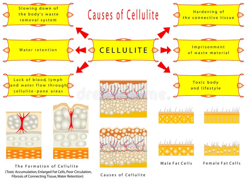 Diversas Etapas De Celulitis Escala De Clasificación Tratamientos ...