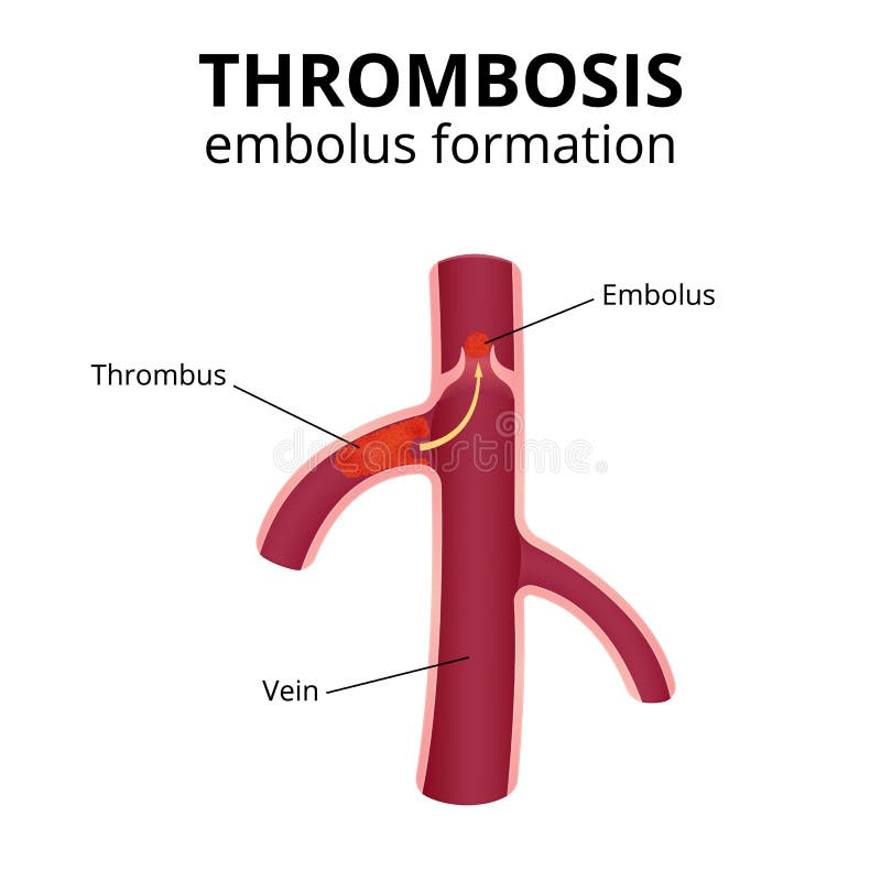 Tejido Pulmonar Humano Con Embolia Pulmonar Debajo De Un Microscopio ...