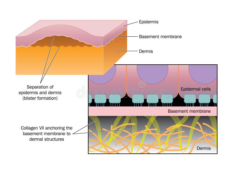 Formation of a blister stock vector. Illustration of collagen - 25279047