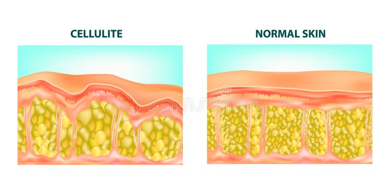 La Formation Des Cellulites. Diagramme De Vecteur Illustration de ...