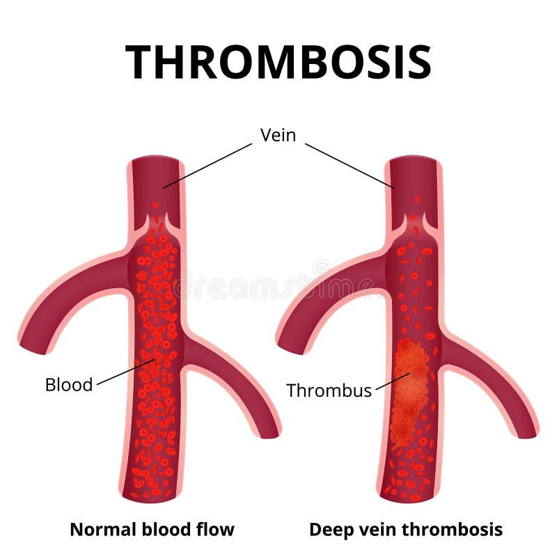 Formazione dell'embolo illustrazione vettoriale. Illustrazione di ...
