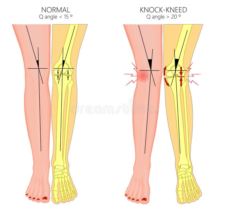 Forme Delle Gambe Gambe Normali E Curve Ginocchia Di Colpo Gamba ...