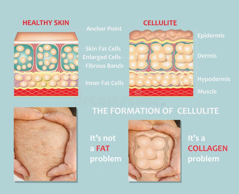 Cellulite Diagram