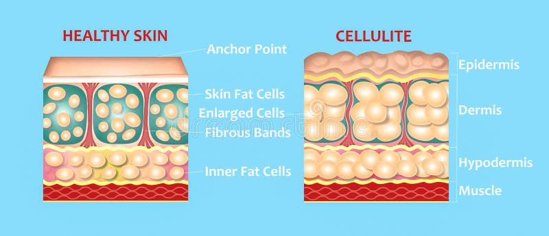 Forming of Underskin Cellulite Illustration Stock Illustration ...
