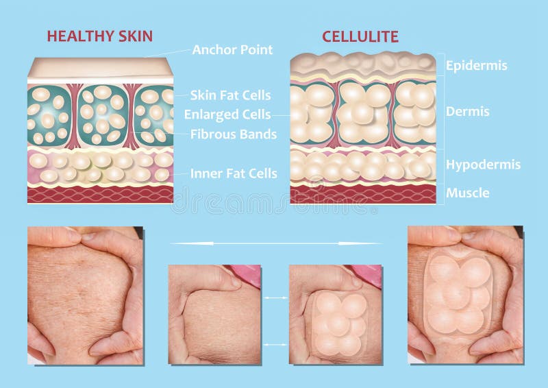 Forming of Underskin Cellulite Illustration Stock Illustration ...