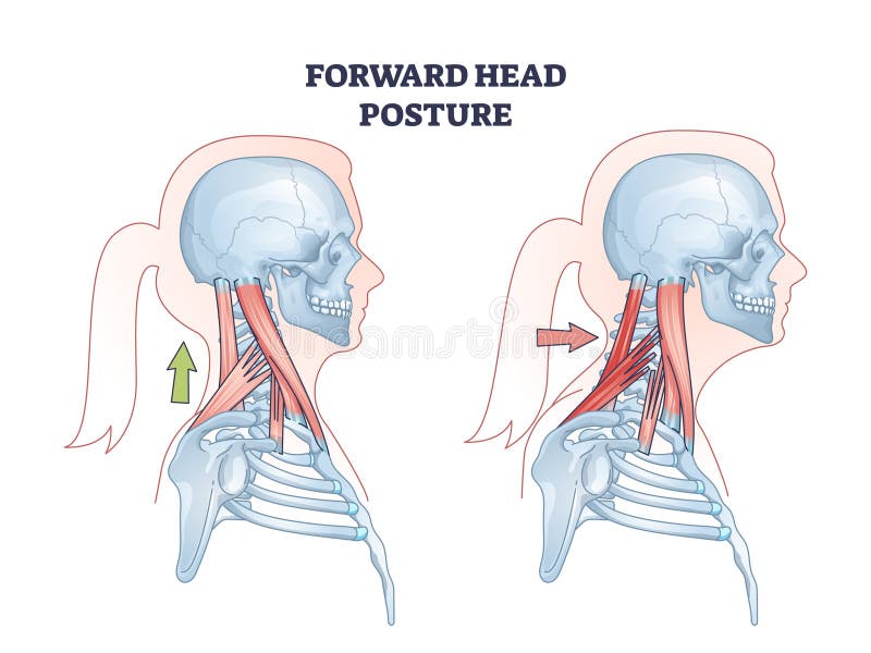 Forward Head Posture Compared with Healthy Neck Position Outline ...