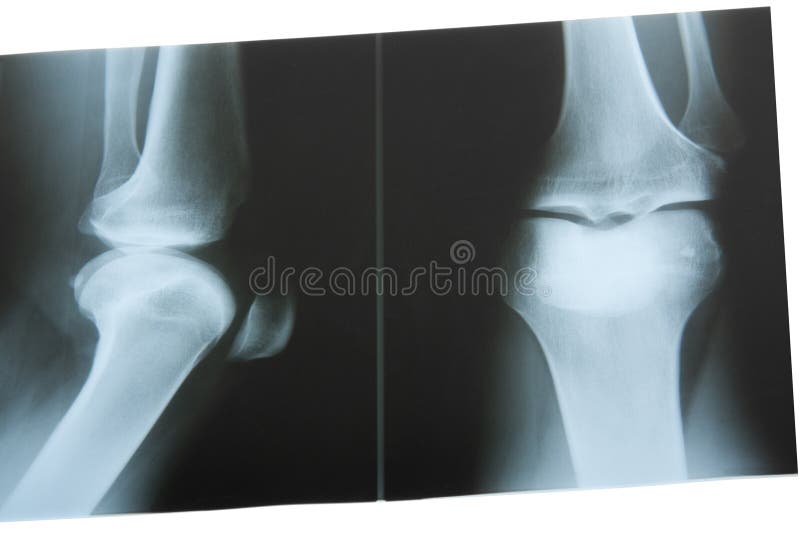 Radiografía De Rodilla Normal Foto de archivo - Imagen de roentgen ...