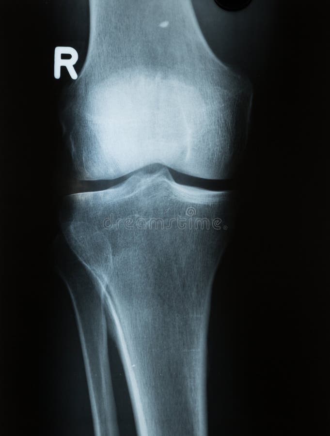Foto Dei Raggi X Di Un Ginocchio Umano Immagine Stock - Immagine di ...