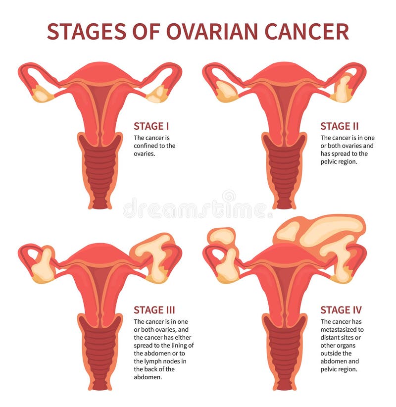 Four Stages Of Ovarian Cancer Isolated White Stock Vector