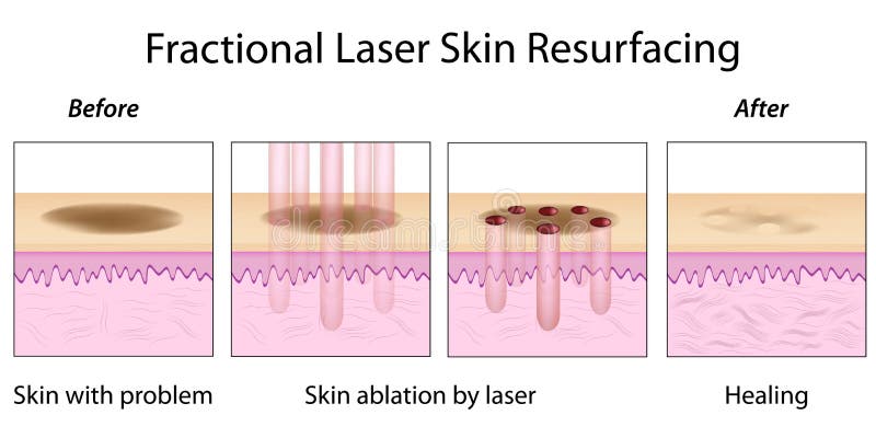 Fractional Laser Skin Resurfacing Stock Vector - Illustration of ...