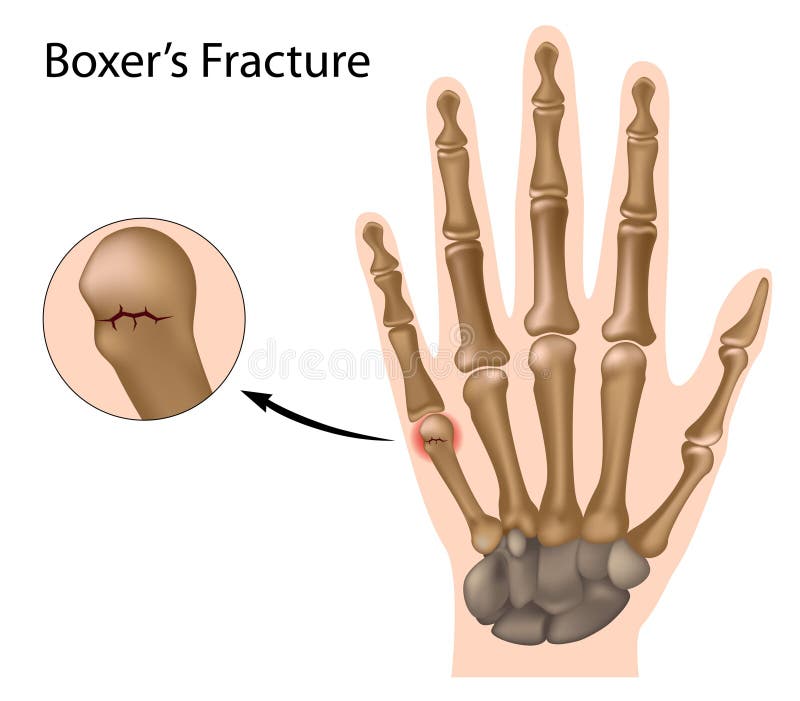 Fractura del boxeador ilustración del vector. Ilustración de lesión ...