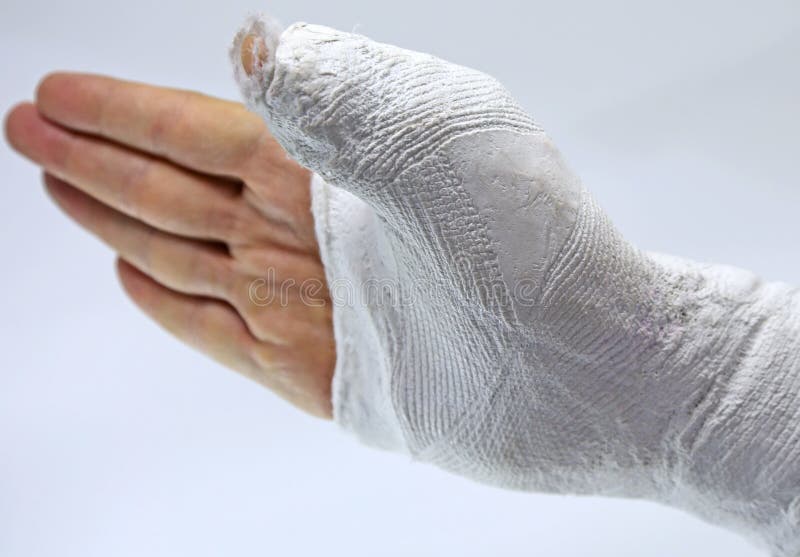 Hueso Fracturado Y Vendaje Del Pulgar Para Inmovilizar El Finger ...