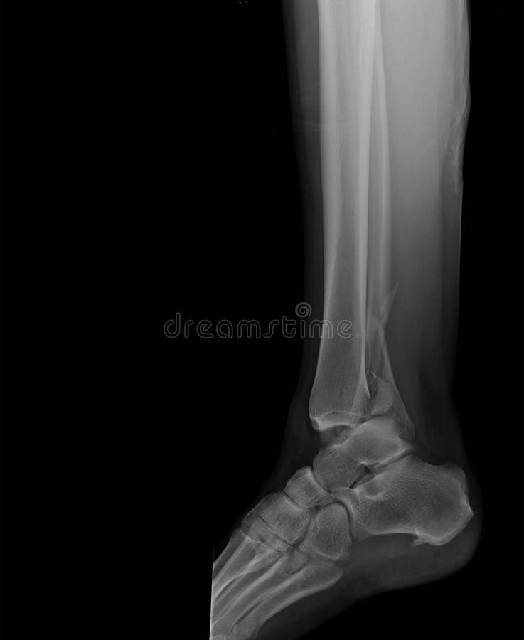 Fracturado foto de archivo. Imagen de llano, dolor, ortopédico - 32395480