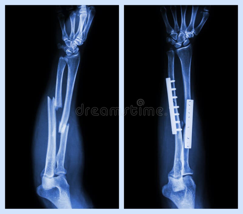 Fracture Both Bone of Forearm. it Was Operated and Internal Fixed with ...