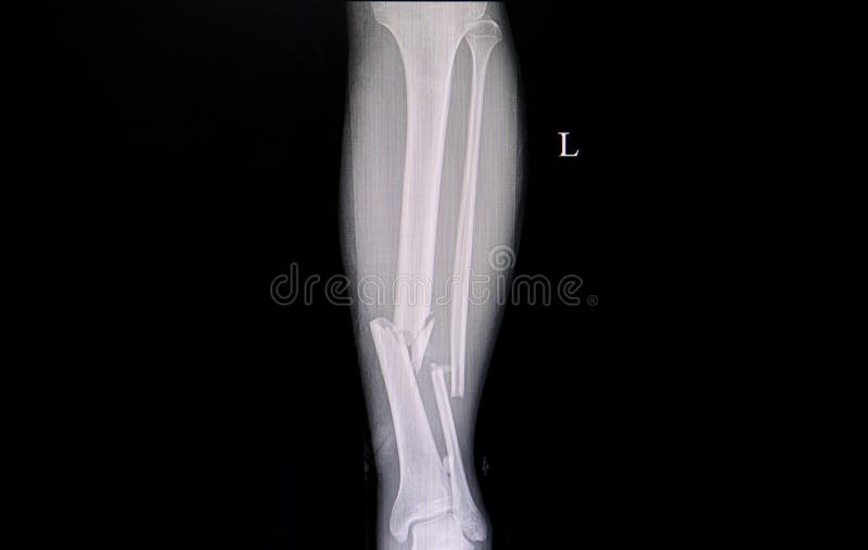 Fracture Both Bones of the Leg Stock Photo - Image of fracture, surgery ...