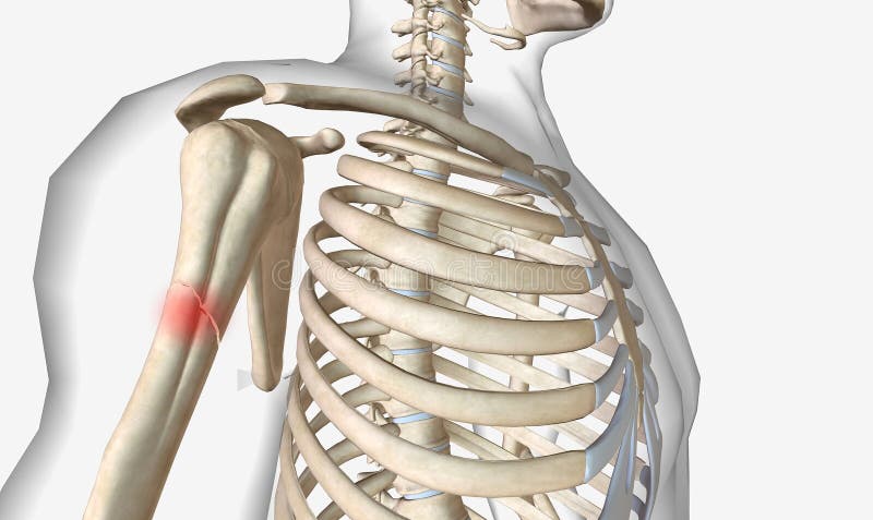 Broken Thigh Bone External Fixation. Fracture of the Thigh Bone and ...