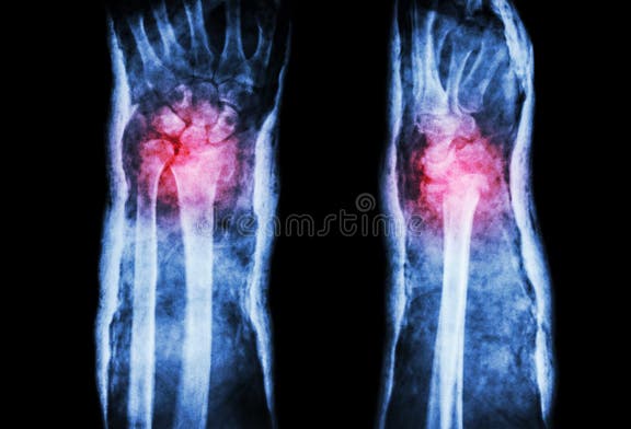Fracture Distal Radius (Colles Fracture) and Cast Stock Photo - Image ...
