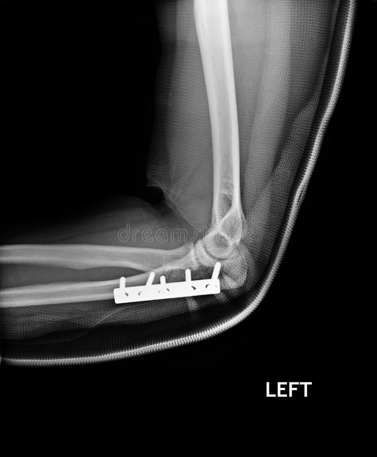 Fracture Elbow, Forearm X-rays Image Showing Plate and Fixation Stock ...