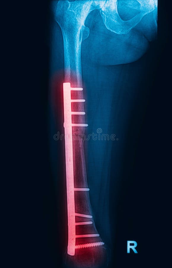 Fracture Femur, Femur X-rays Image Stock Photos - Image: 28481333