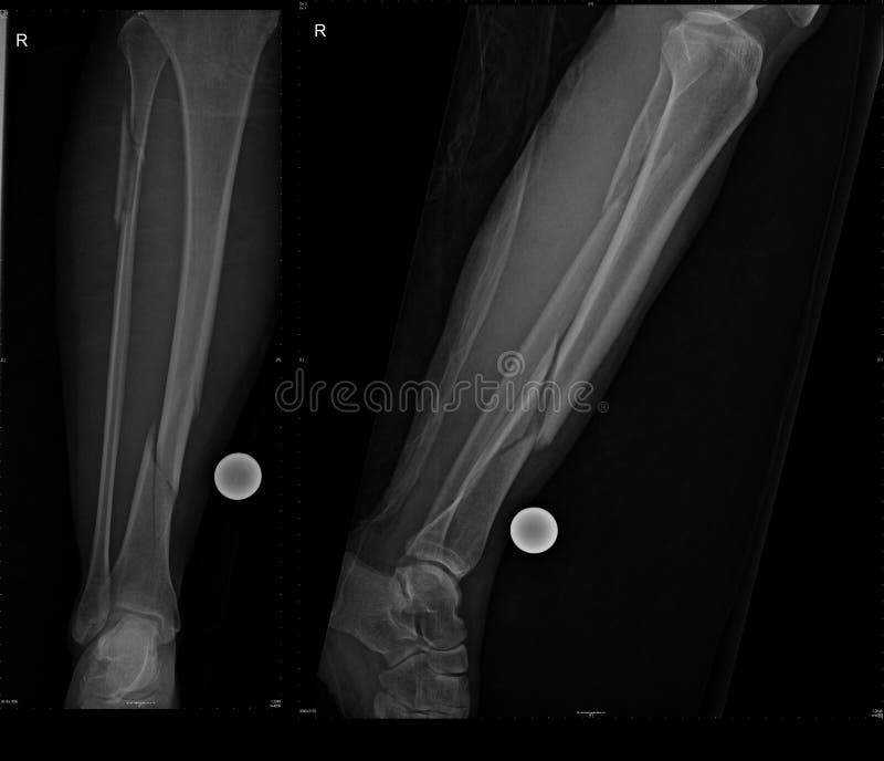 Fracture of Fibular and Tibial Bone Stock Photo - Image of injury ...