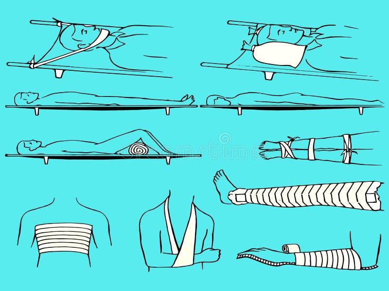 Fracture first aid stock illustration. Illustration of doctor - 24174655