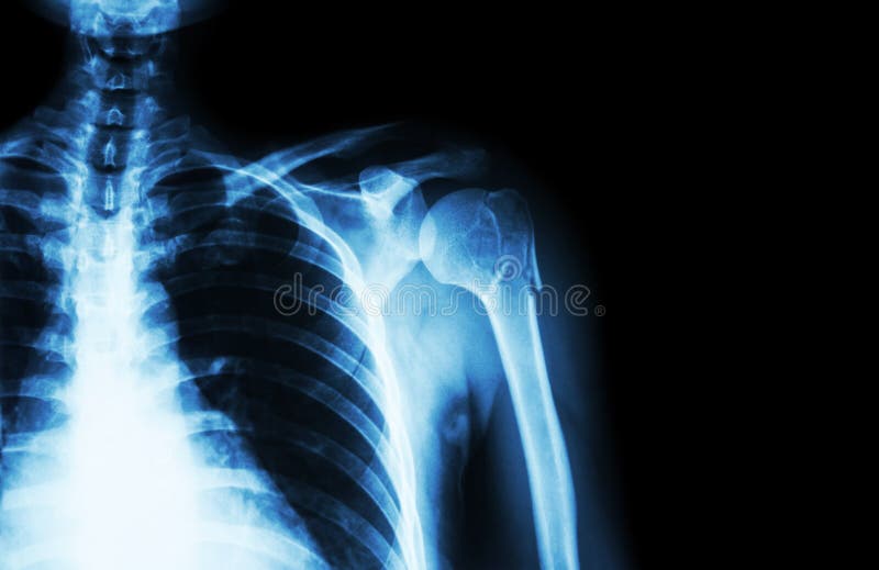 Fracture at Neck of Humerus ( Arm Bone ) ( Film X-ray Left Shoulder and ...