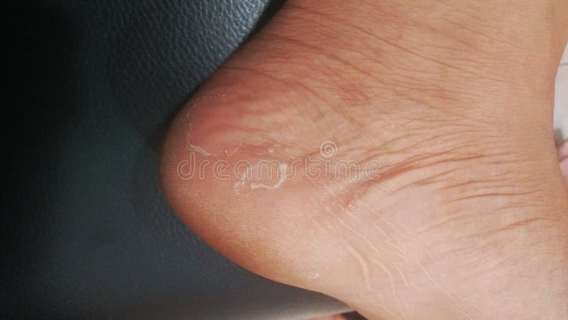 Fracture of the Outer Skin at the Toe Stock Image - Image of outer ...