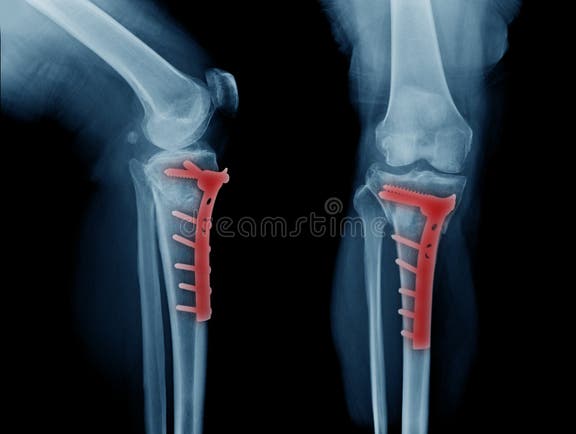 Fracture Proximal Tibia with Internal Fixation AP and Lateral View ...