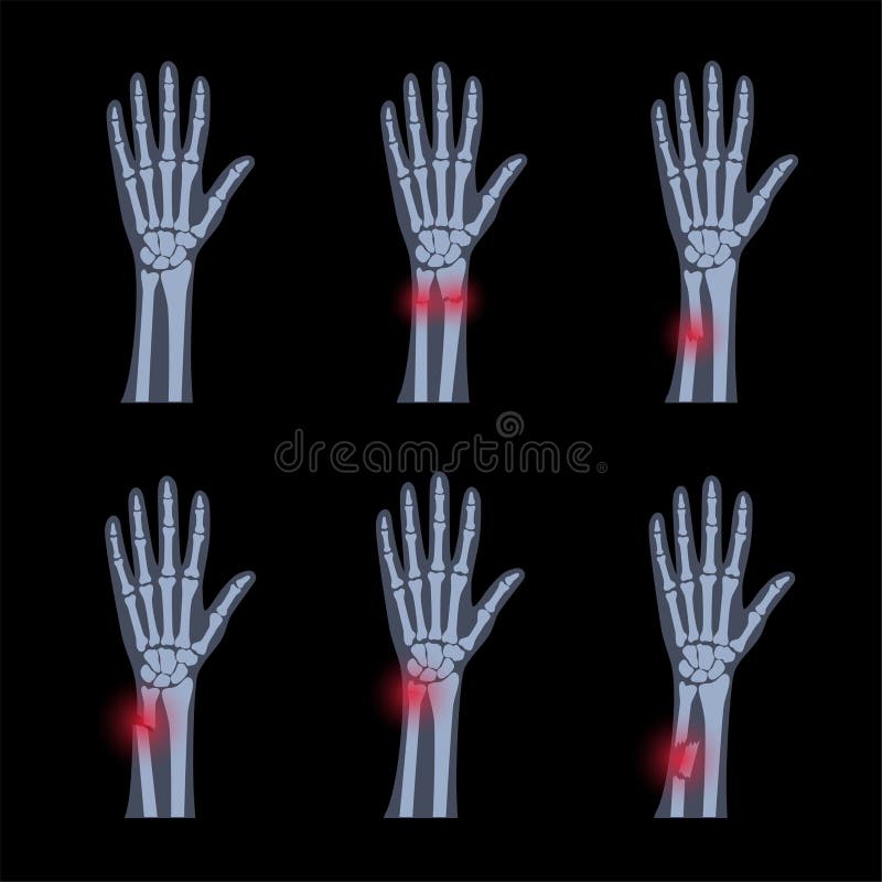 Fracture x ray concept stock vector. Illustration of hospital - 196552157