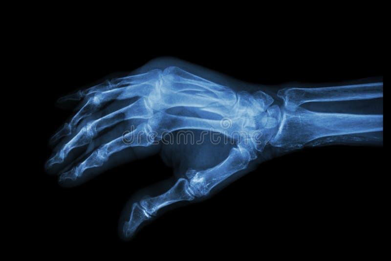 15,503 Hand Fracture Freeland Stock Photos - Free & Royalty-Free Stock ...