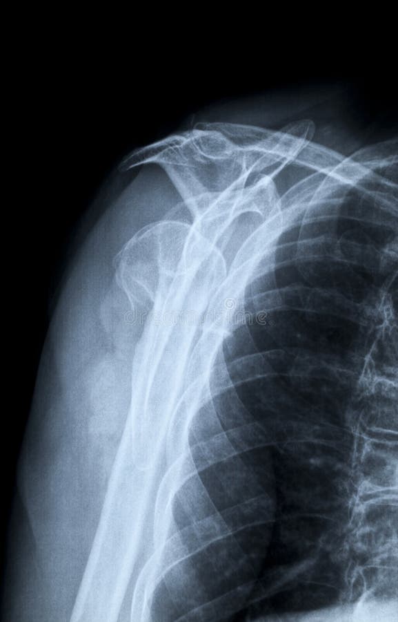 Fracture of a Right Human Upper Arm after Accident Stock Photo - Image ...