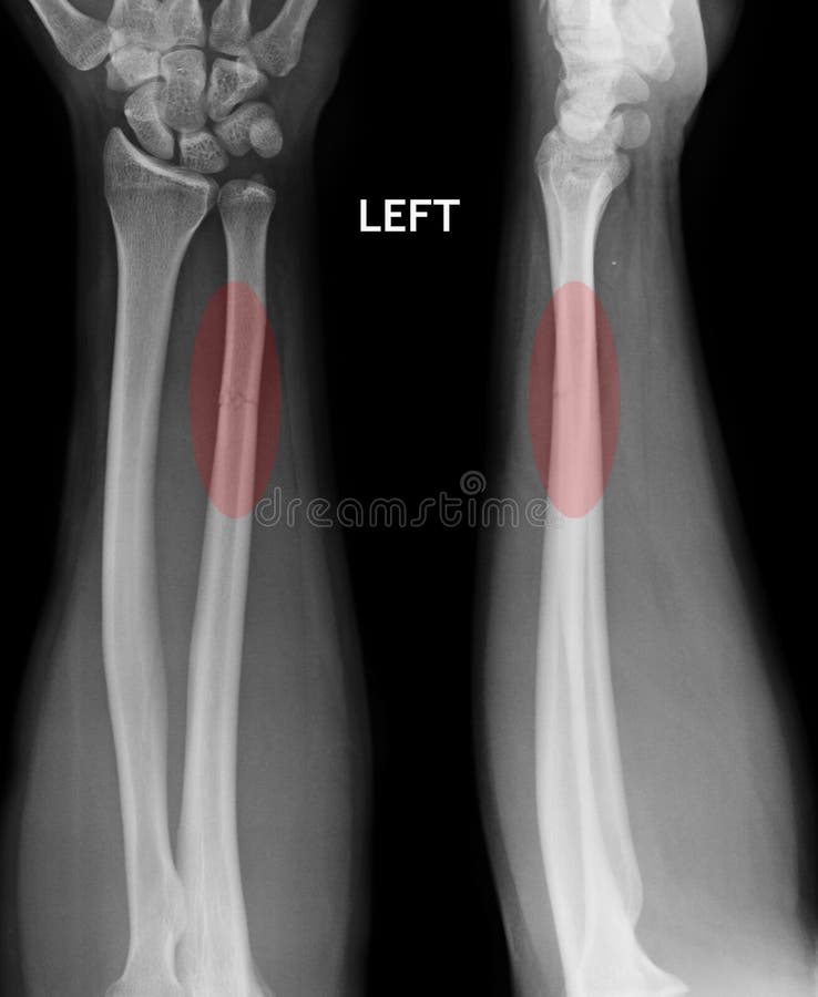 Fracture Shaft of Radius & Ulnar Bone Stock Photo - Image of elbow ...