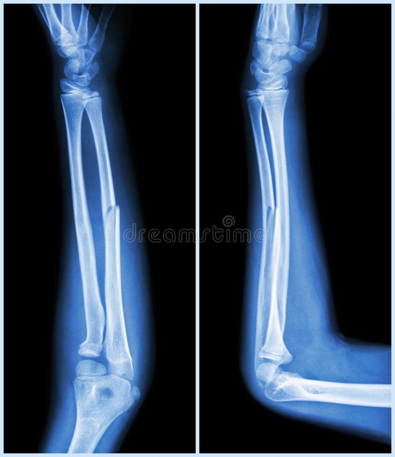 Fracture Shaft of Ulnar Bone ( Forearm Bone ) : ( Front and Side View ...