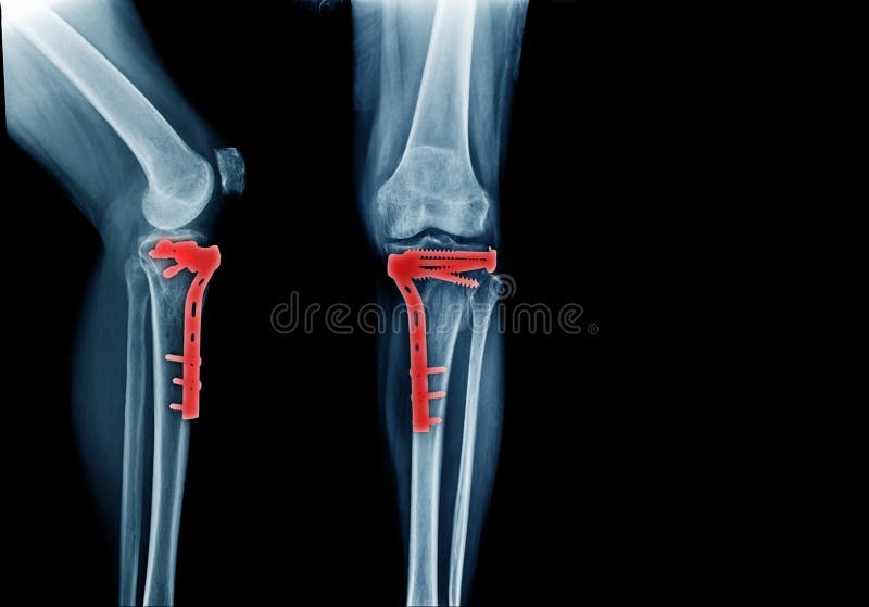 Fracture Proximal Tibia with Internal Fixation AP and Lateral View ...