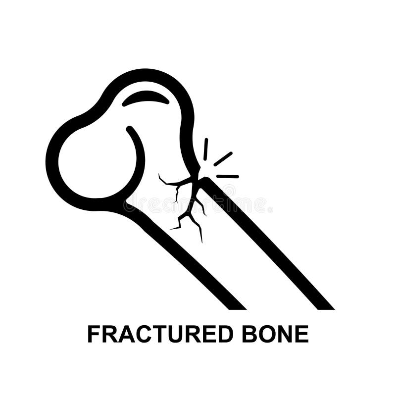 Fractured Bone Icon. Types of Spiral Fractures in Human Isolated on ...
